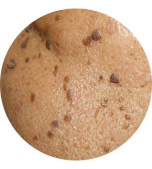 DPN Removal Treatment - Get Rid of Dermatosis Papulosa Nigra