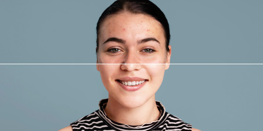 AHA Peel For Acne Scars & Hyperpigmentation: 7 Skin Benefits