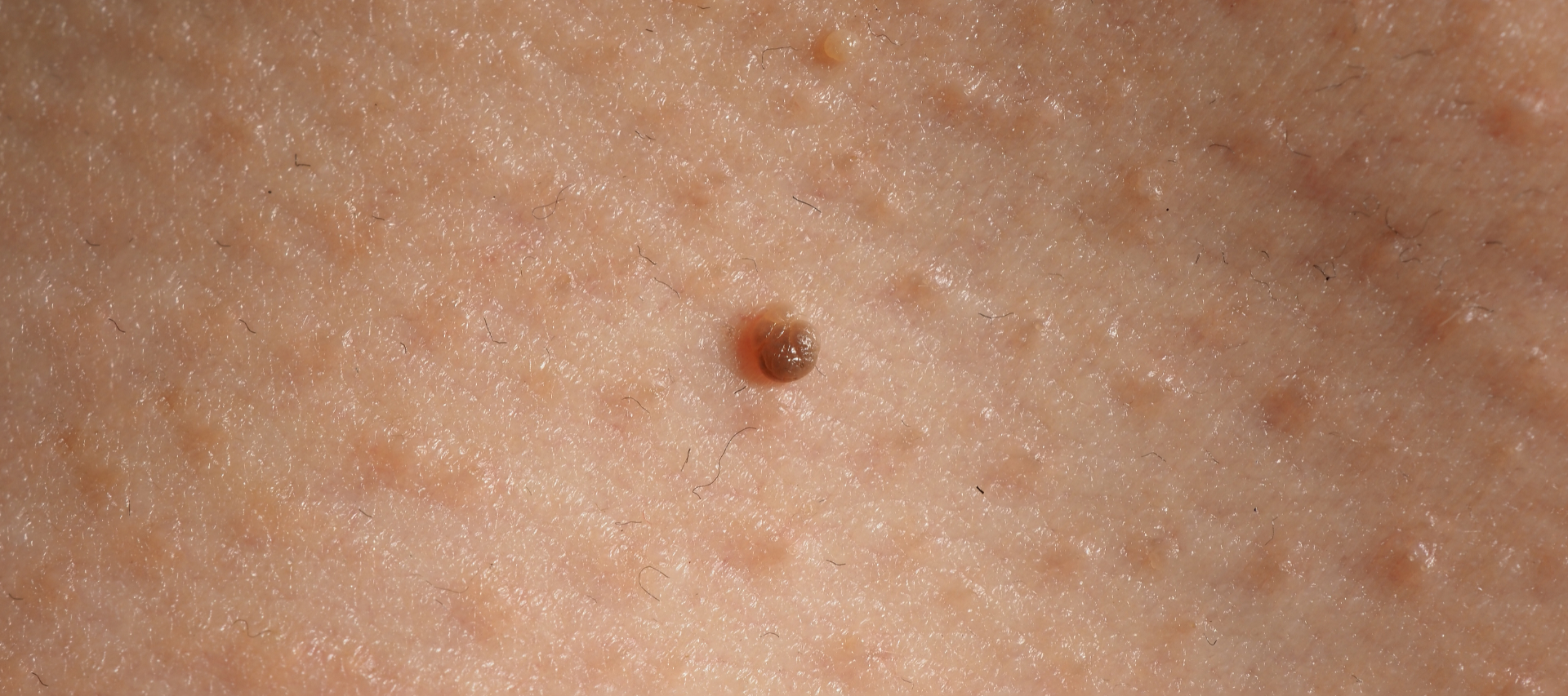 Genital Skin Tags: 11 Causes, Signs, Treatments, Prevention
