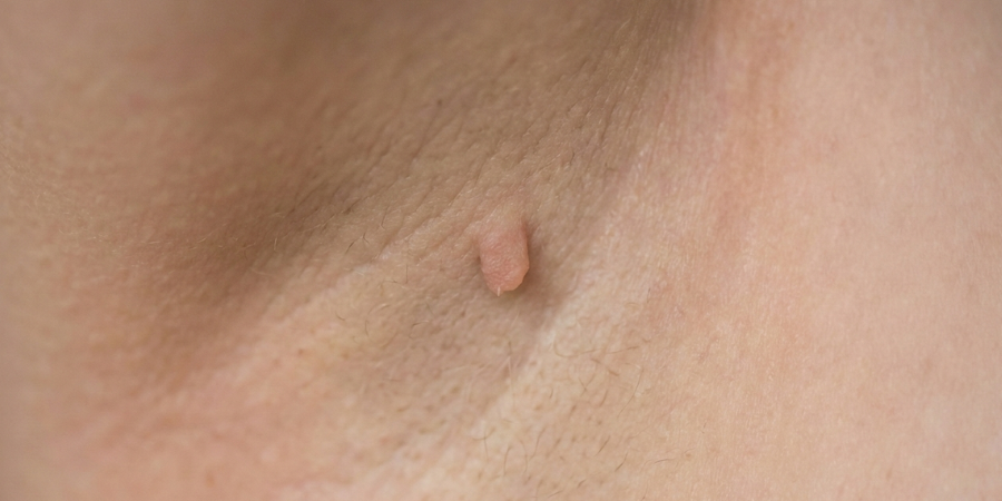 Armpit Skin Tag Explained: Causes, Risks & Safe Removal